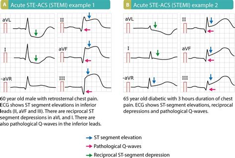 Figure 4 Two Examples Of Patients With Stemi St Elevation Myocardial Infarction Only Limb