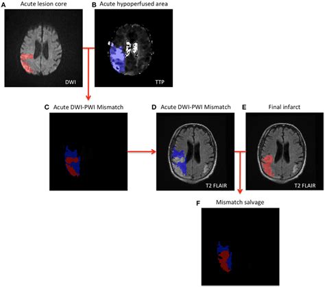 Schematic Illustration Of Mismatch Salvage Computation Ab The Acute Download Scientific