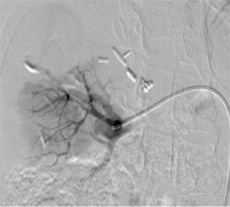 Figure 2 From Renal Artery Pseudoaneurysm After Partial Nephrectomy