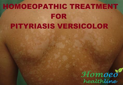 Pityriasis Versicolor And Homoeopathy