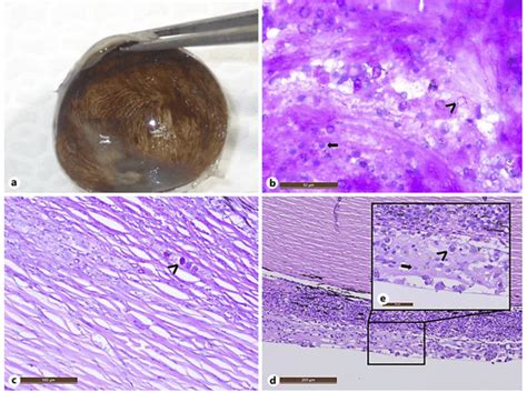 Anatomopathological Examination Of The Enucleated Left Eye A Showed