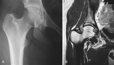 Arthroscopic Synovectomy And Treatment Of Synovial Disorders Clinical