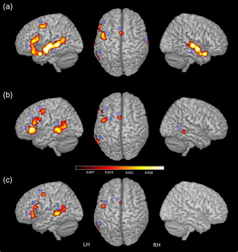 Left Hemisphere Midline And Right Hemisphere Views Of Significant