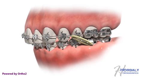 Class Ii Elastics Youtube