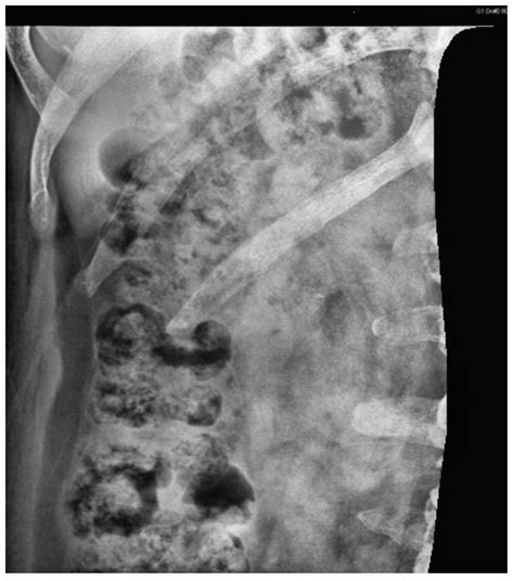 Bioengineering Free Full Text Design And Validation Of A Deep Learning Model For Renal Stone
