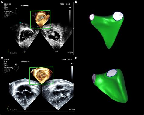3decho Rv Volume Assessment Example Of Rv Volumes Acquired From A Download Scientific