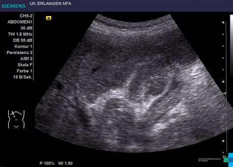 Gallbladder Perforation Atlas Of Ultrasound