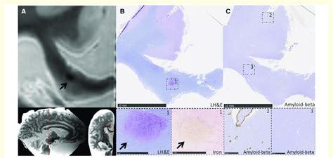 Cerebral Microbleed Located In The Splenium Of The Corpus Callosum A Download Scientific