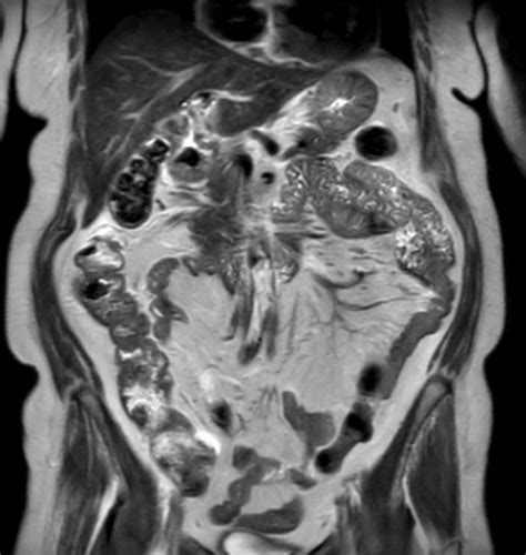 Nice Mri Image Of A Stone Filled Gallbladder Sorin Cimpean