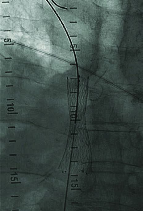 Superior Vena Cava At The Time Of Stent Deployment Download