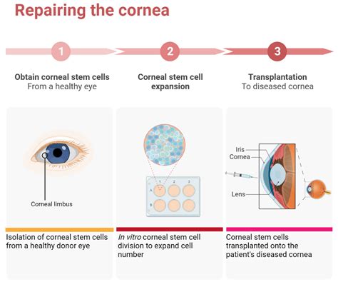 Eye Disease How Could Gene And Cell Therapy Help Eurogct