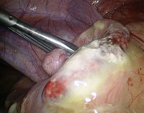 Perforated Appendicitis Laparoscopy DocCheck