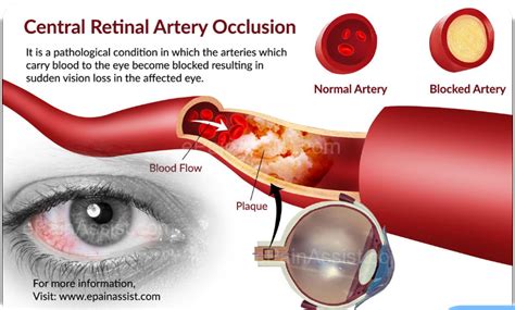 Retinal Artery Occlusion The Dada2 Foundation
