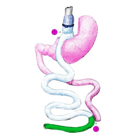 Brygb Diabetes Surgery