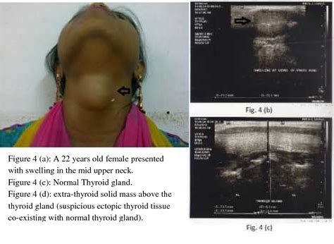 Ectopic Thyroid