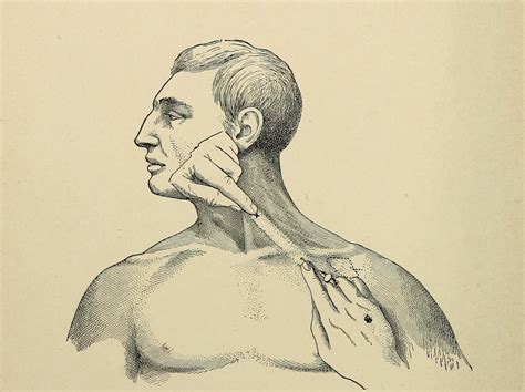 Nemfrog Anesthesia Of The Brachial Plexus By The