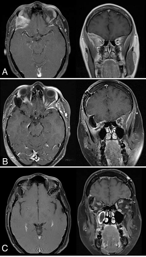 Figure 1 From The Management Of Symptomatic Hyperostotic Bilateral
