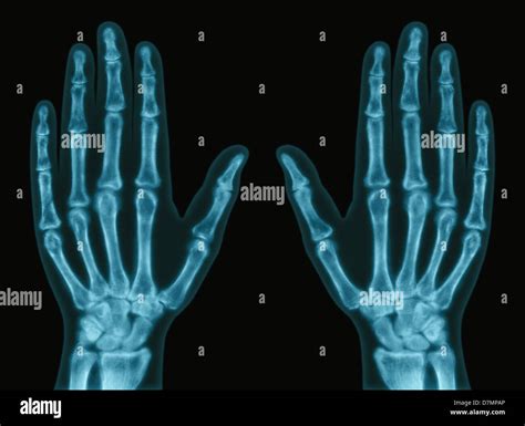X Ray Hand Normal