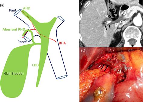 Figure 2 From Multidetector Ct In Detection Of Troublesome Posterior Sectoral Hepatic Duct