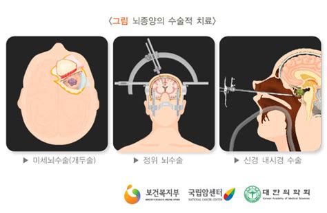 영남대학교병원 암센터 암정보 암종별 정보 뇌종양