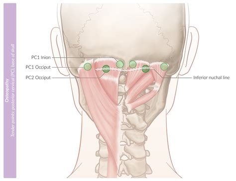 Posterior Trigger Points Neck