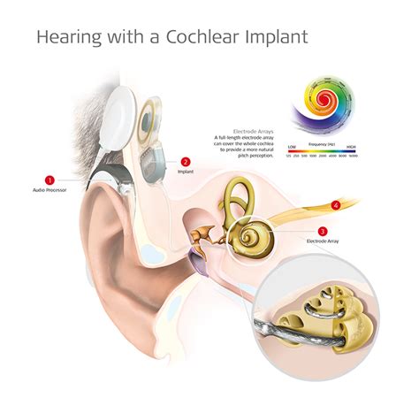 Cochlear Implant Lokman Hekim Health Group