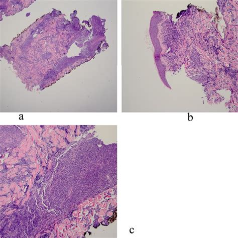 A Left Back Nodules B Left Back Nodules Download Scientific Diagram