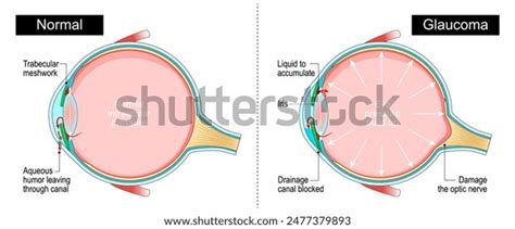 Glaucoma Patient Over 1 521 Royalty Free Licensable Stock Illustrations Drawings Shutterstock