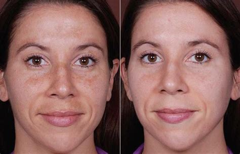 Contour Dermatology Melasma Treatment Results With Obagi Nuderm Kit