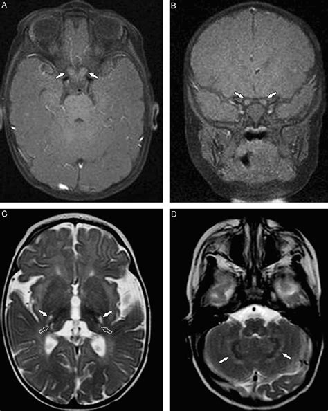 Figure 1 From Positional Ocular Flutter And Thickened Optic Nerves As