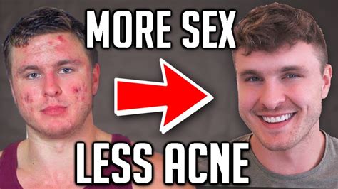 Does Sex IMPROVE Acne BIG DISCOVERY YouTube
