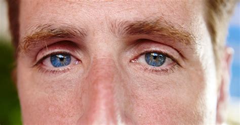 Ocular Melanoma Symptoms Causes Treatment