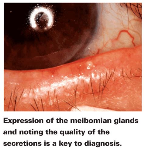 Meibomian Gland Expression