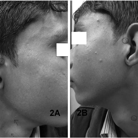 Clinical Photograph Of The Second Patient Showing A A Preauricular Download Scientific