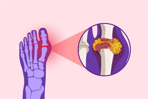 What Is Gout Healthywomen What Is Gout Healthywomen