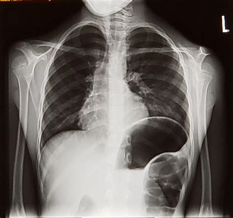 รายการ 102 ภาพพนหลง ภาพ X Ray ใหมทสด
