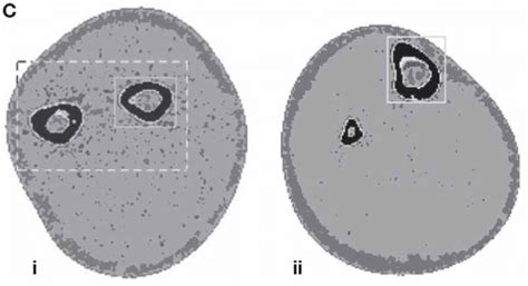 Peripheral Quantitative Computed Tomography The Scan Site Is Located