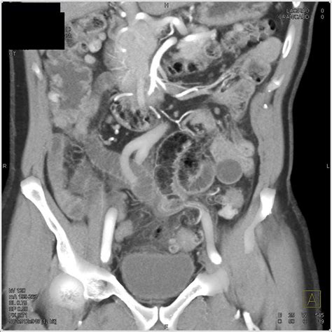 Focal Sigmoid Diverticulitis With Perforation Colon Radiology Case