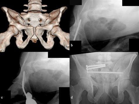 Preoperative 3d Surface Rendered Ct Scan Outlet Image A Demonstrating Download Scientific
