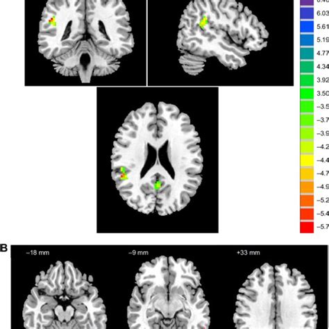 The RsFc Differences Between The SD Group And The RW Group Notes A Download Scientific