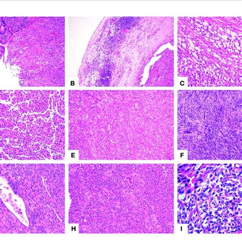 Immunohistochemical And Molecular Findings Of The Smarca4 Deficient Download Scientific
