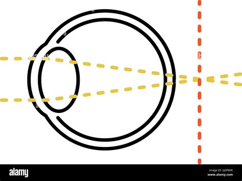 Medical Illustration Of Visual Acuity And Refractive Error Hyperopia Focus Behind The Retina