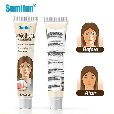 Мазь для лечения белых пятен на теле Крем для усиления пигментации при витилиголейкодерма лишай