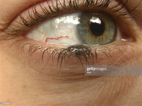 Intradermal Nevus Eyelid