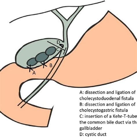 The Postoperative Cholangiogram Confirmed A Normal Bile Duct With