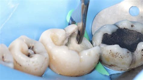 To Cover Or Not To Cover The Cusp That Is The Question Myzerodonto