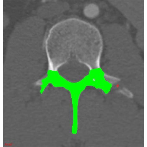 A Posterior Element Fracture B Posterior Element Segmentation Download Scientific Diagram
