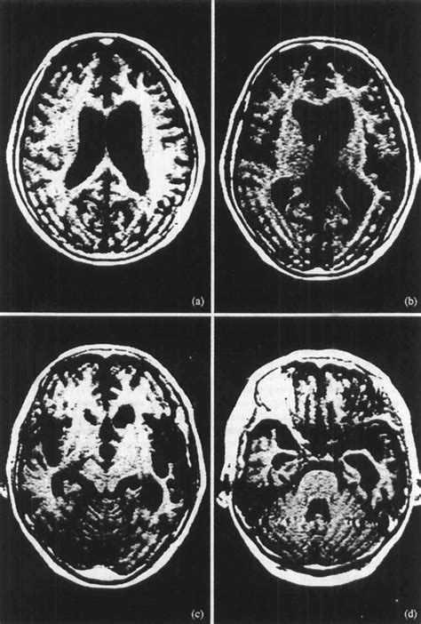 Four Sections From The Axial T Weighted Mri Scan For Nk Performed In Download Scientific
