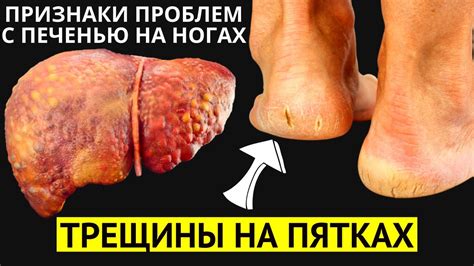 По НОГАМ Определяем Состояние ПЕЧЕНИ 10 Сигналов проблем с печенью на ногах 5 Продуктов Для