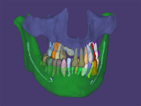 Segmentation Of Cbct Data Using The Diagnocat™ Software Diagnocat